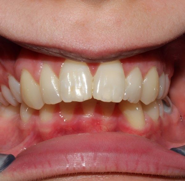 Common Orthodontic Problems | Mayer Orthodontics