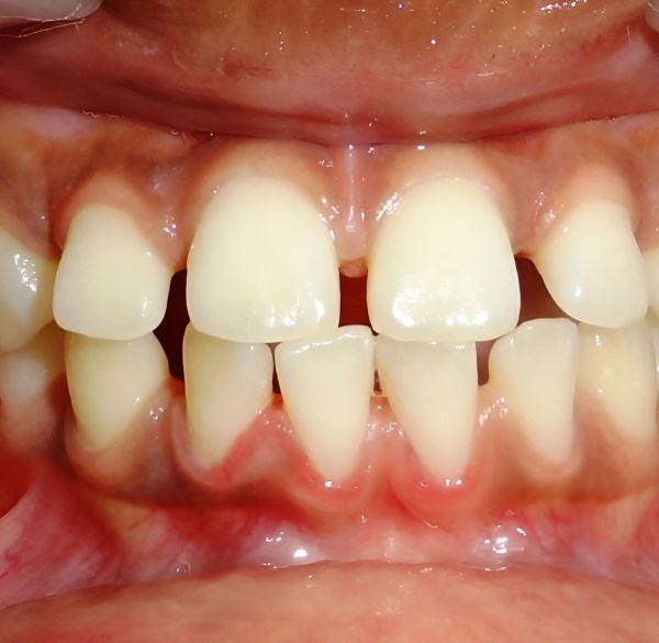 Common Orthodontic Problems | Mayer Orthodontics