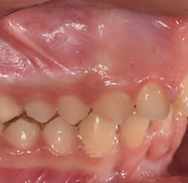 Common Orthodontic Problems | Mayer Orthodontics